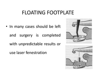 Otosclersis and stapes surgical management | PPTX