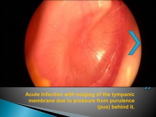 Otoscope and its uses | PPTX
