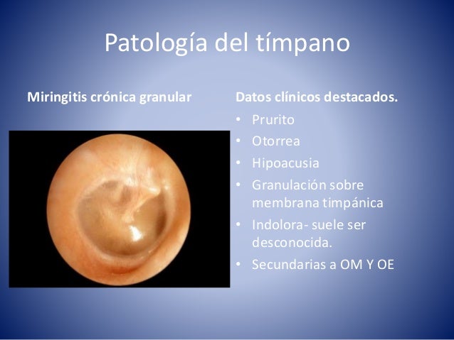 Otoscopia