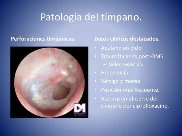 Otoscopia