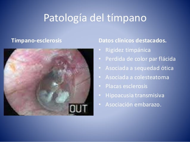 Otoscopia