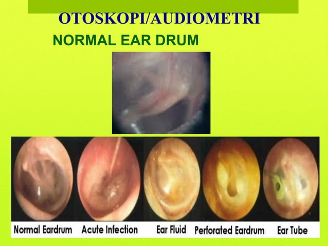 Otoskopi Audiometri | PPT