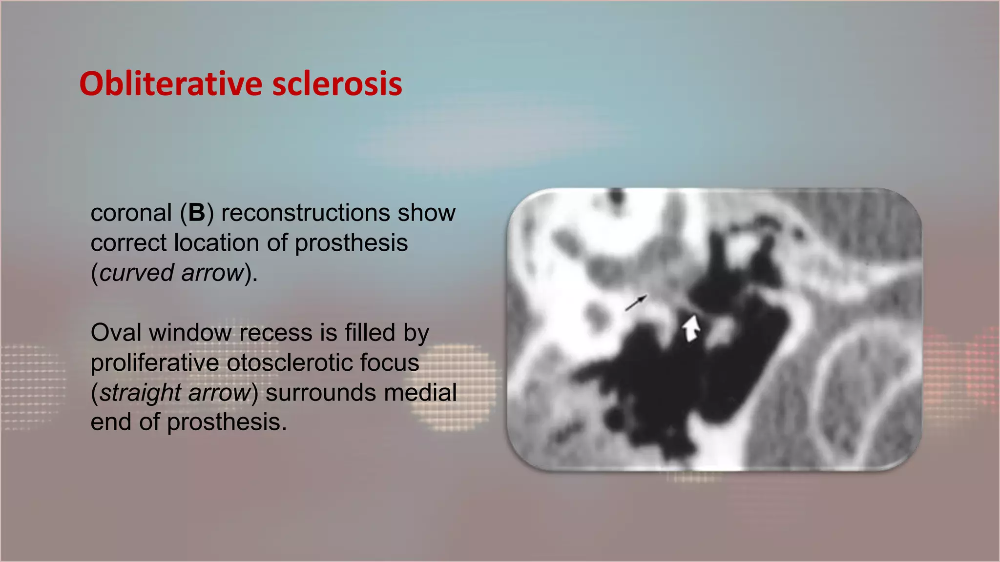 Otosclerosis | PPTX