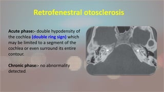 Otosclerosis | PPTX