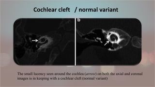 Otosclerosis | PPTX