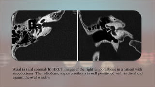 Otosclerosis | PPTX