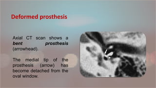 Otosclerosis | PPTX