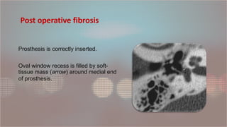 Otosclerosis | PPTX