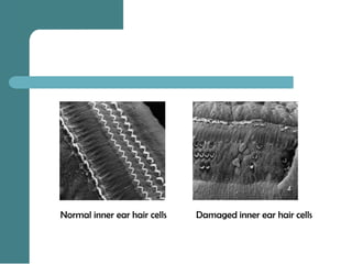 Ototoxicity | PDF