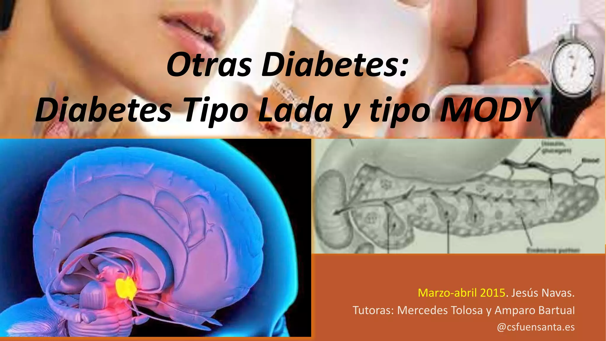 Otras Diabetes: Diabetes Tipo Lada y tipo MODY | PPTX | Diabetes ...
