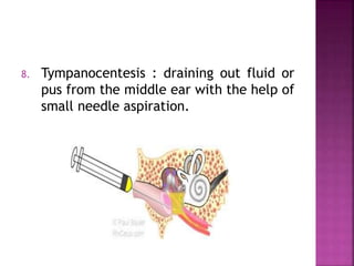 Ottis media n.pptx otitis media infection | PPTX