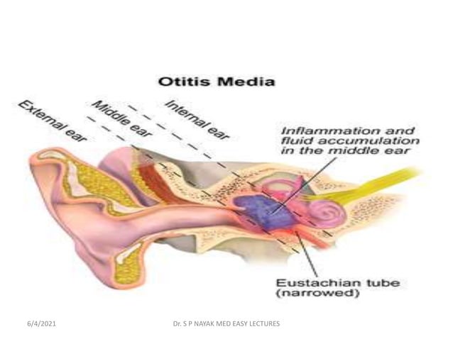 Otitis media basic concepts | PPT