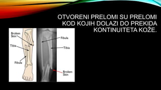 Otvoreni prelomi | PPTX