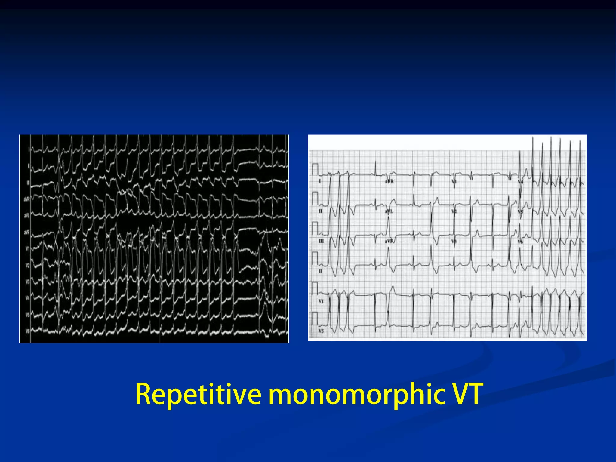 Out Flow tract VT, Diagnostic Tools and Ablation Weapons | PDF