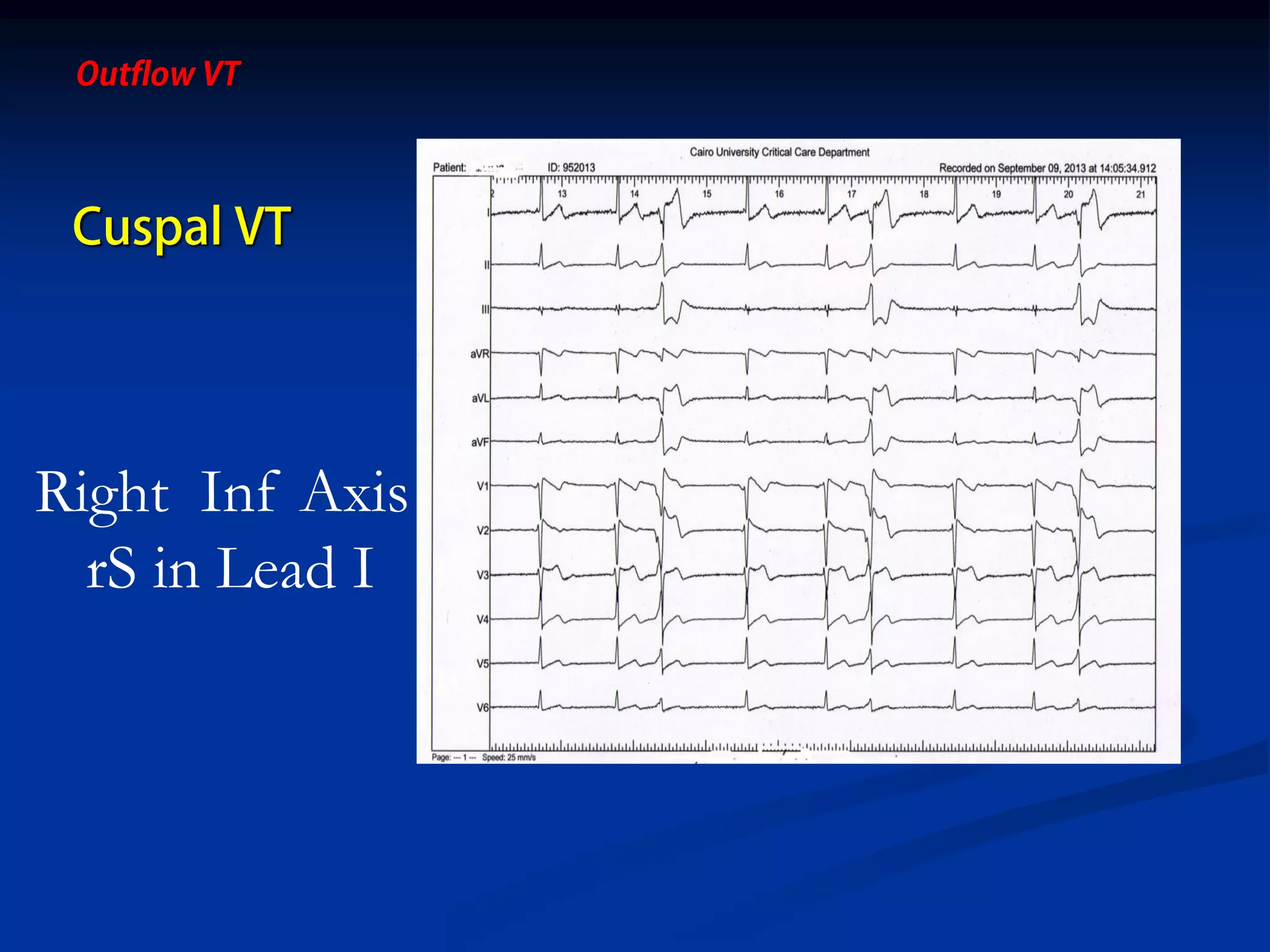 Out Flow tract VT, Diagnostic Tools and Ablation Weapons | PDF