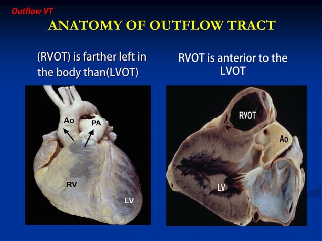Out Flow tract VT, Diagnostic Tools and Ablation Weapons | PPT
