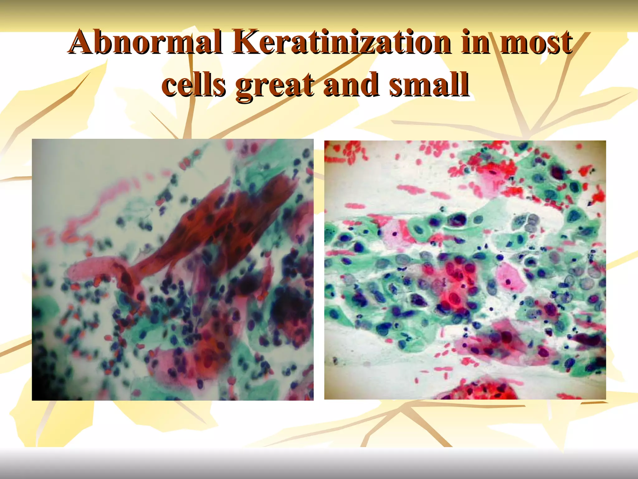 Out of africa. cytomorphology of cells on cervical smears from HIV ...