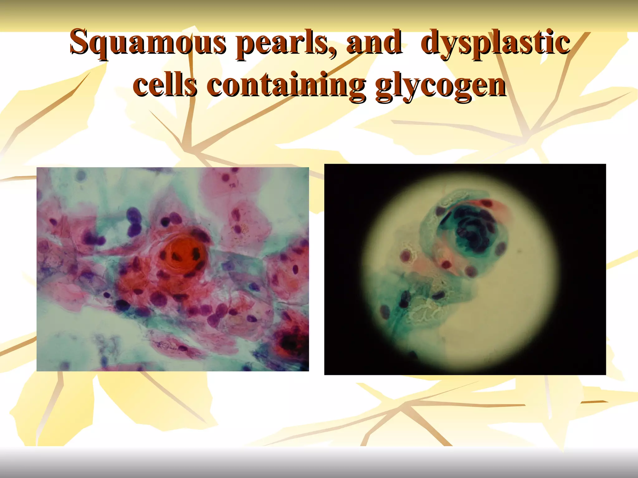 Out of africa. cytomorphology of cells on cervical smears from HIV ...