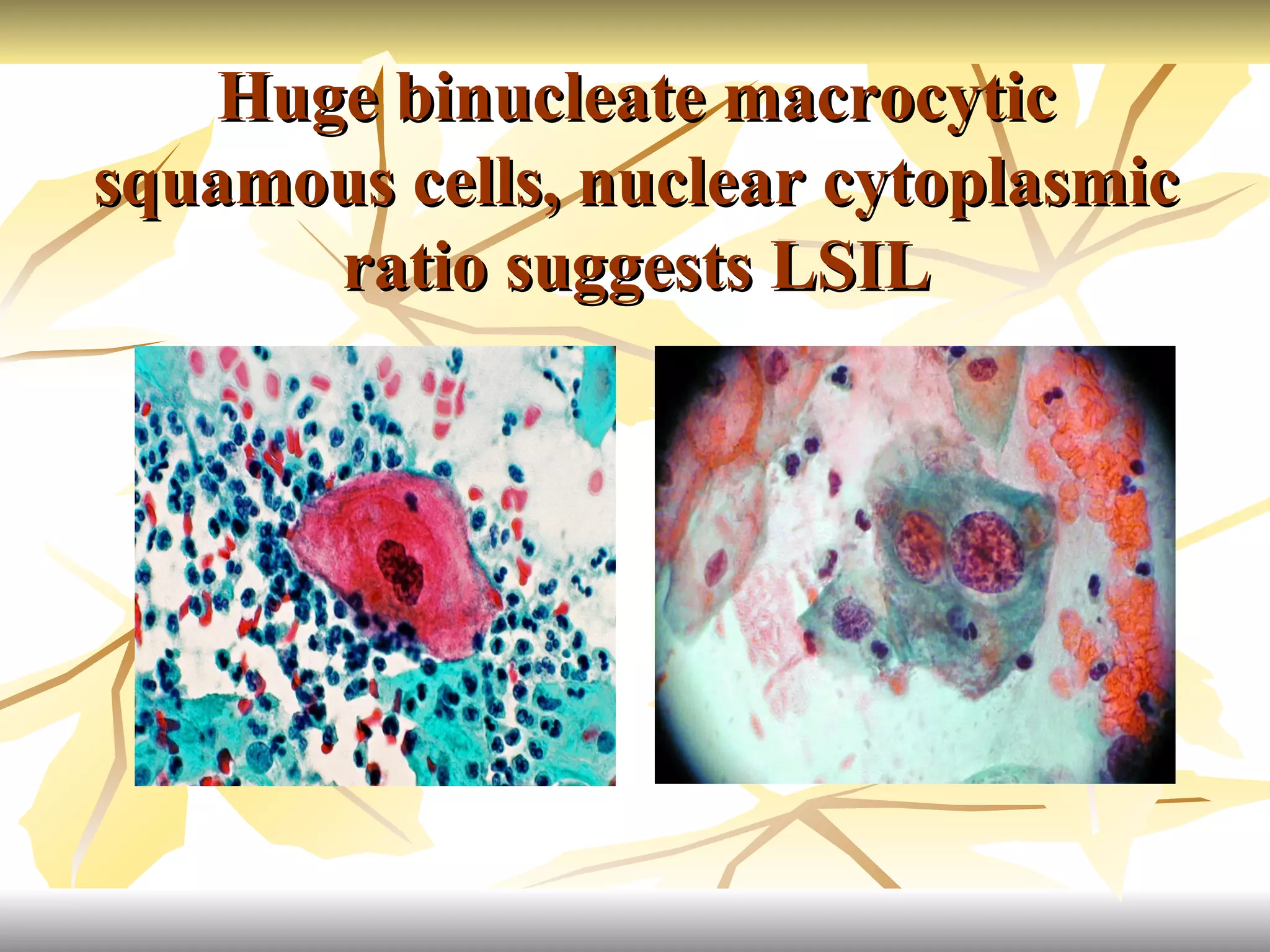 Out of africa. cytomorphology of cells on cervical smears from HIV ...