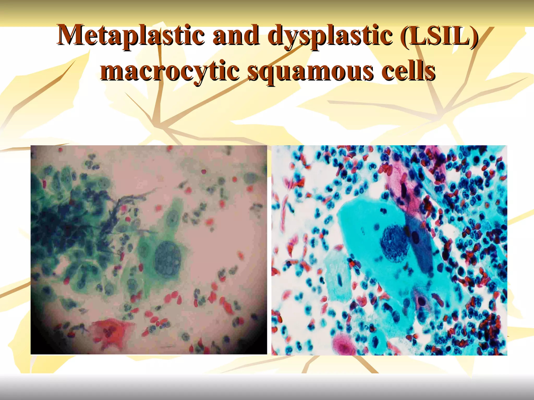 Out of africa. cytomorphology of cells on cervical smears from HIV ...
