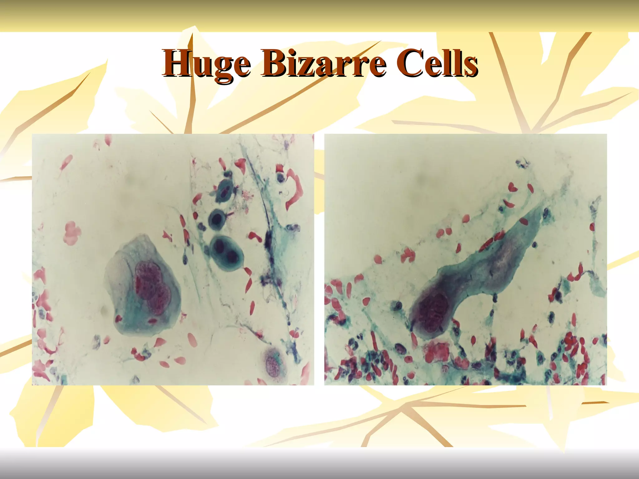 Out of africa. cytomorphology of cells on cervical smears from HIV ...