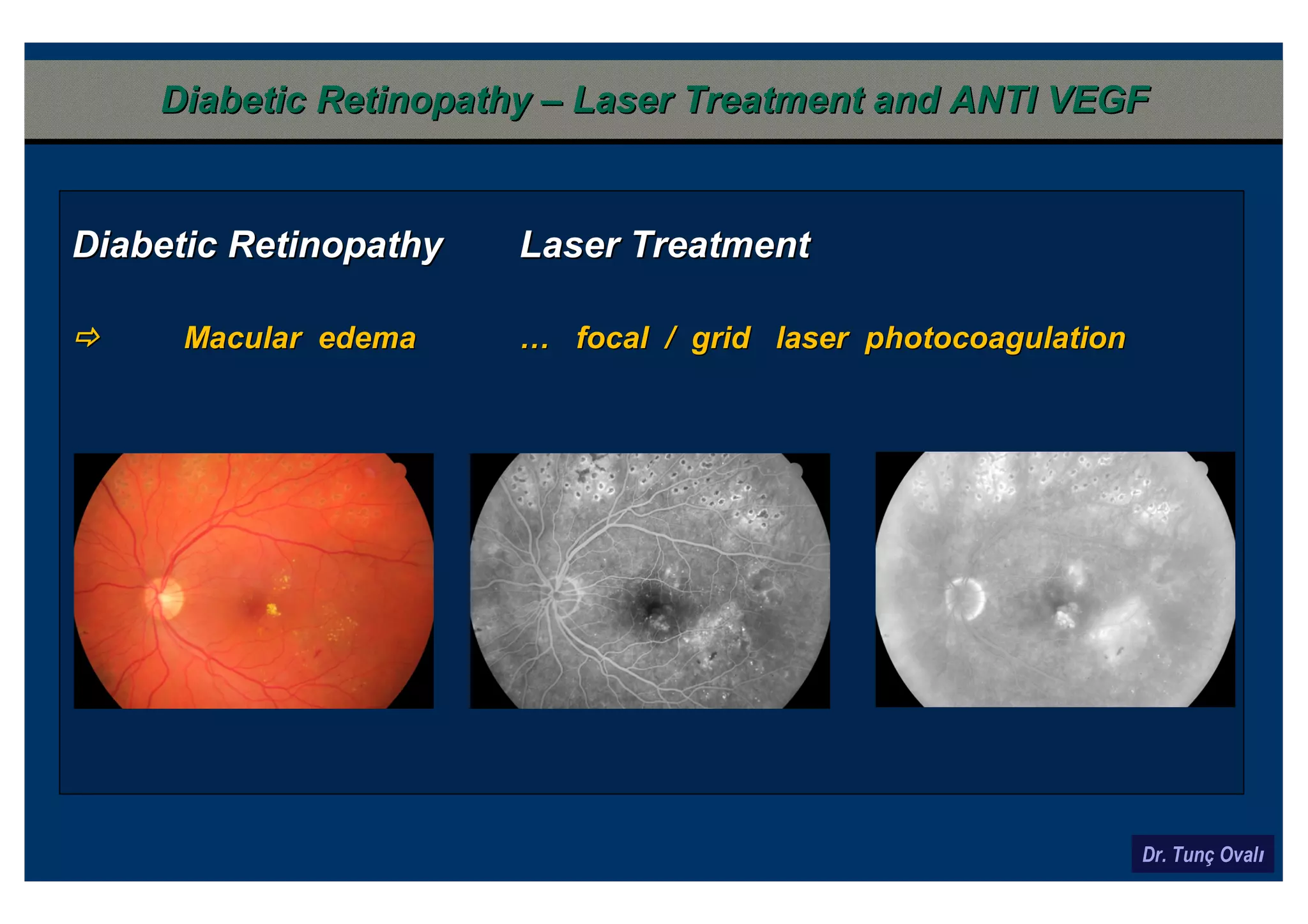 Ovali diabetic retinopathy laser treatment anti vegf | PDF
