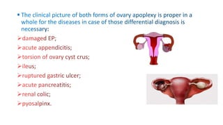 OVARIAN APOLEXY, RUPTURE OF YELLOW BODY ,OVARY BLEEDING. | PPTX