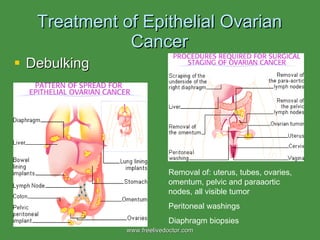 Ovarian Omentum Removal – Omentectomy Definition – EQIUWY