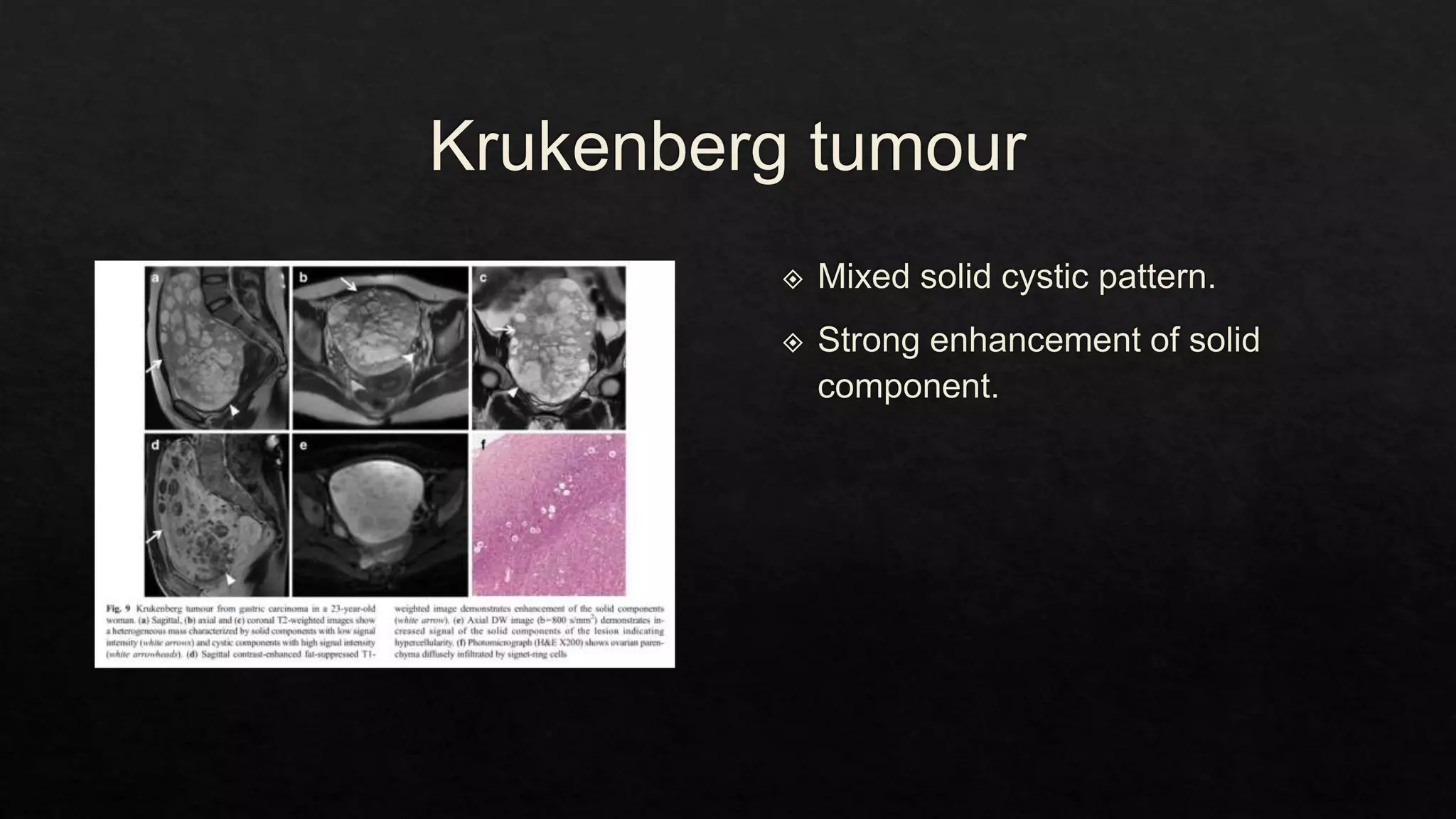Ovarian Cancer Ppt Vp Pptx