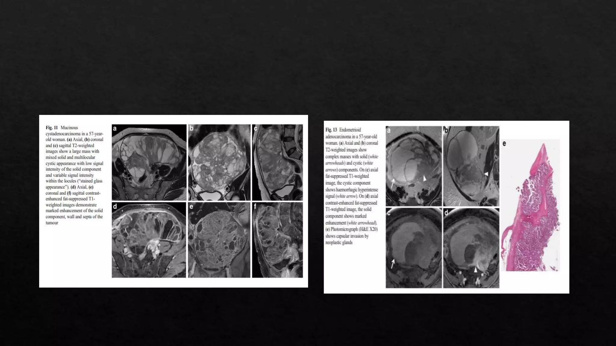 Ovarian Cancer Ppt Vp Pptx
