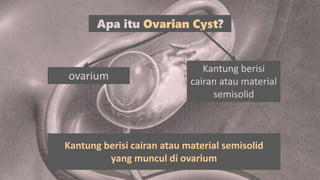 Ovarian Cyst | PPTX