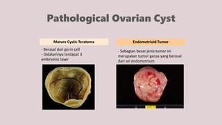 Ovarian Cyst | PPTX