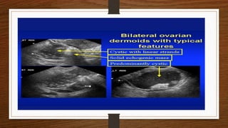 Ovarian CYST.pptx