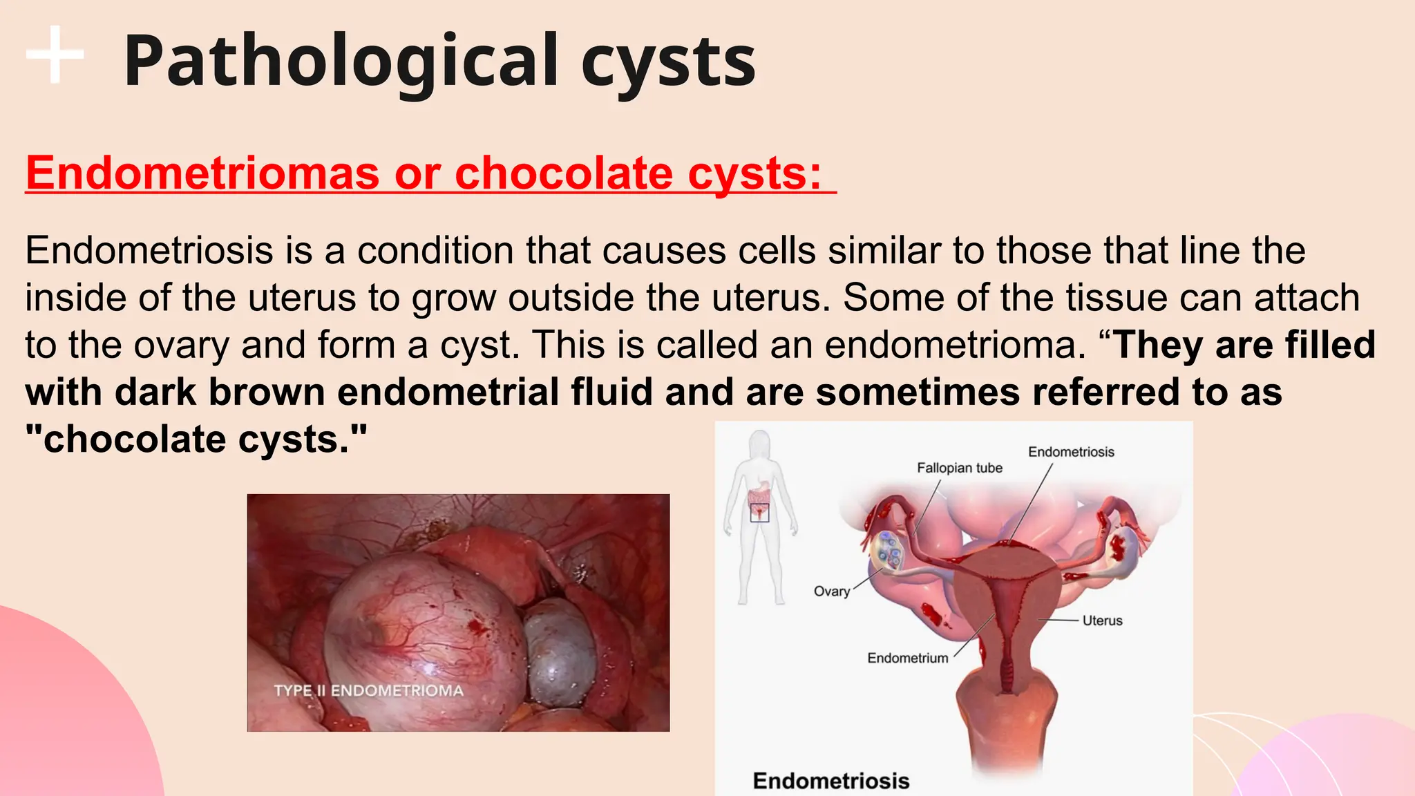 Ovarian Cyst.pptx