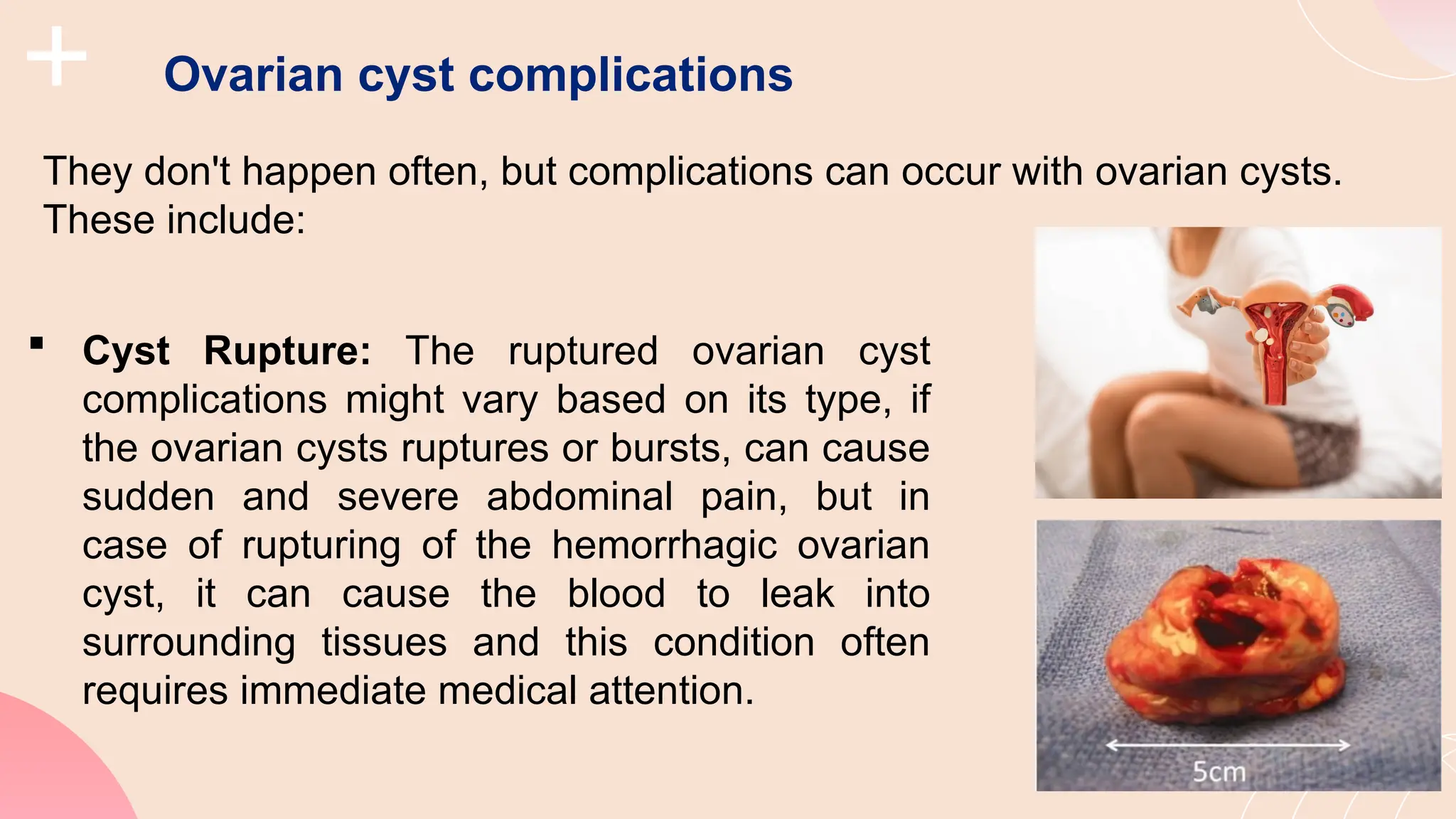 Ovarian Cyst.pptx