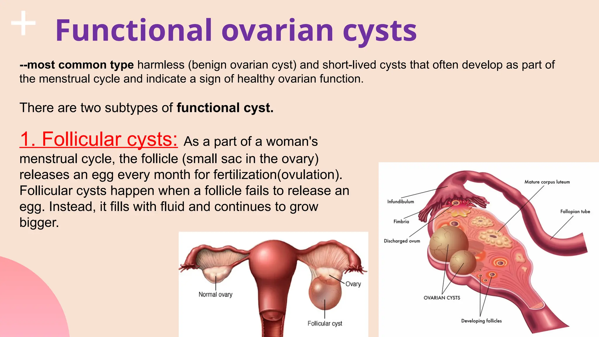Ovarian Cyst.pptx