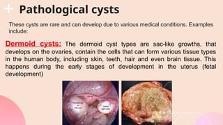 Ovarian Cyst.pptx