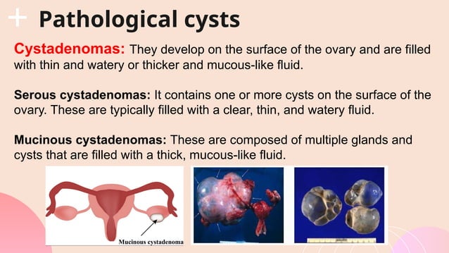 Ovarian Cyst.pptx