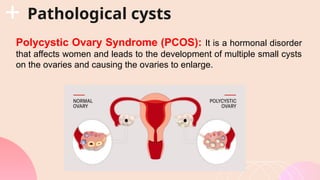 Ovarian Cyst.pptx