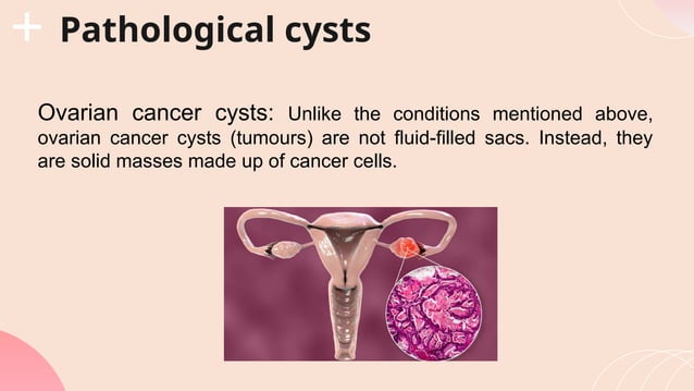 Ovarian Cyst.pptx