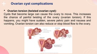 Ovarian Cyst.pptx