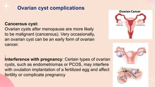 Ovarian Cyst.pptx
