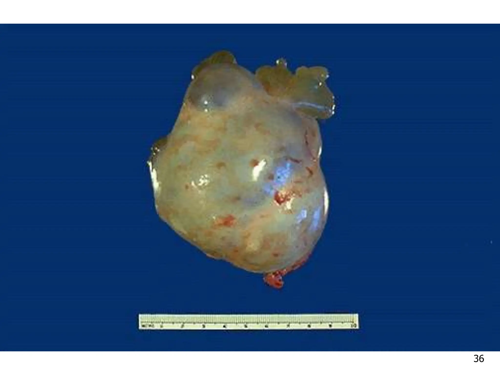 Ovarian cyst and tumors women female.ppt