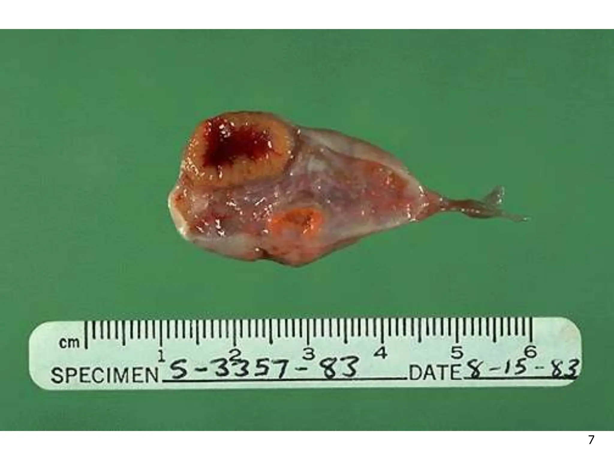 Ovarian cyst and tumors women female.ppt