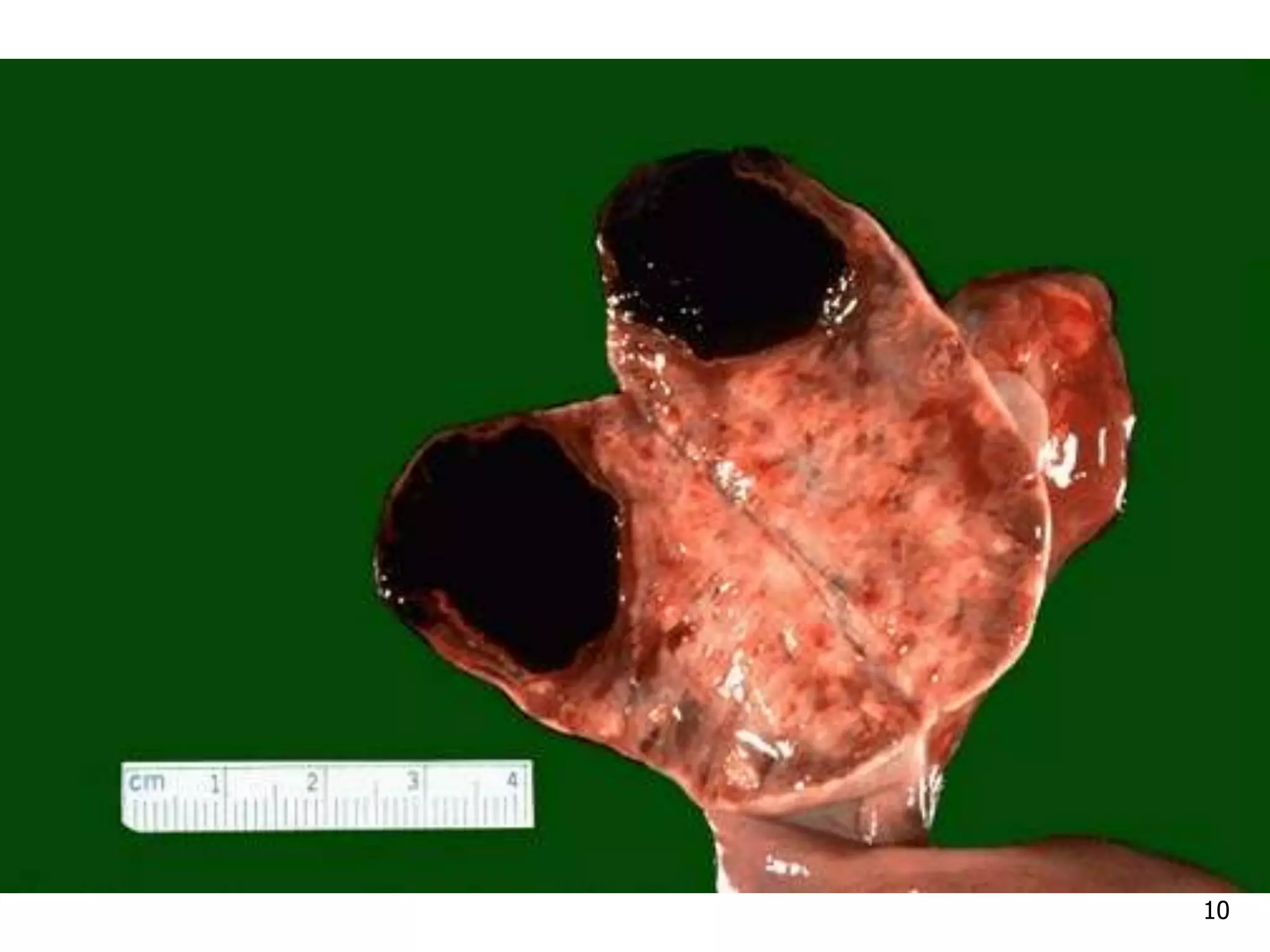 Ovarian cyst and tumors 2009.ppt