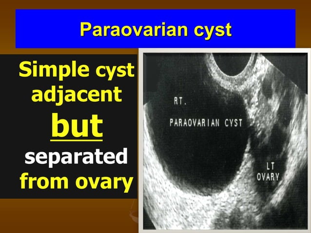 Ovarian cyst aspiration | PPT