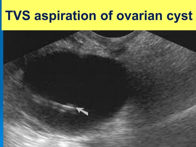 Ovarian cyst aspiration | PPT