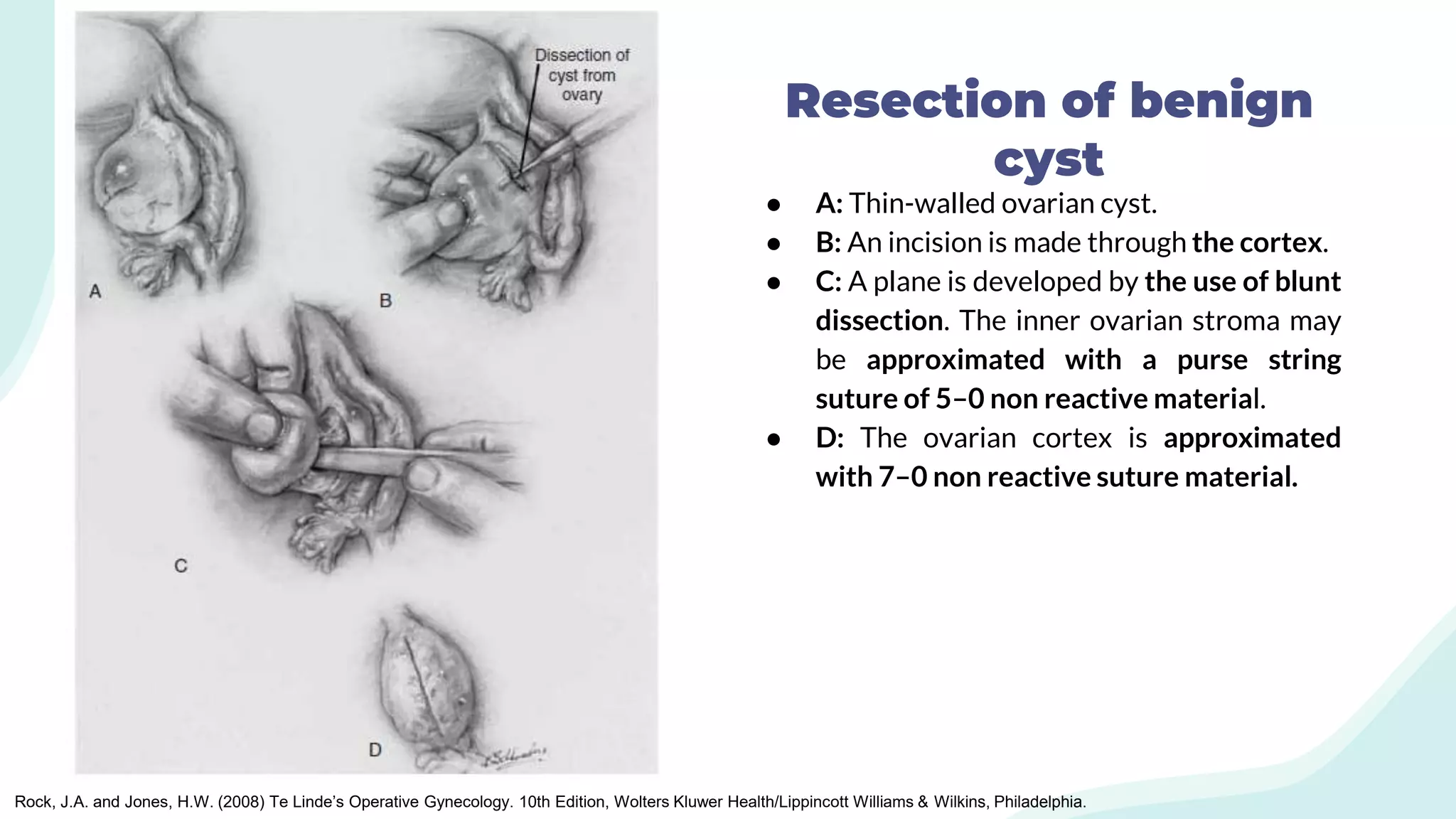 Ovarian Cyst Decision Making - Abdul.pptx