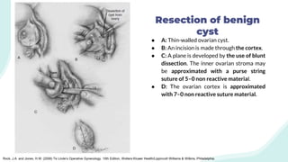 Ovarian Cyst Decision Making - Abdul.pptx