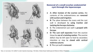 Ovarian Cyst Decision Making - Abdul.pptx